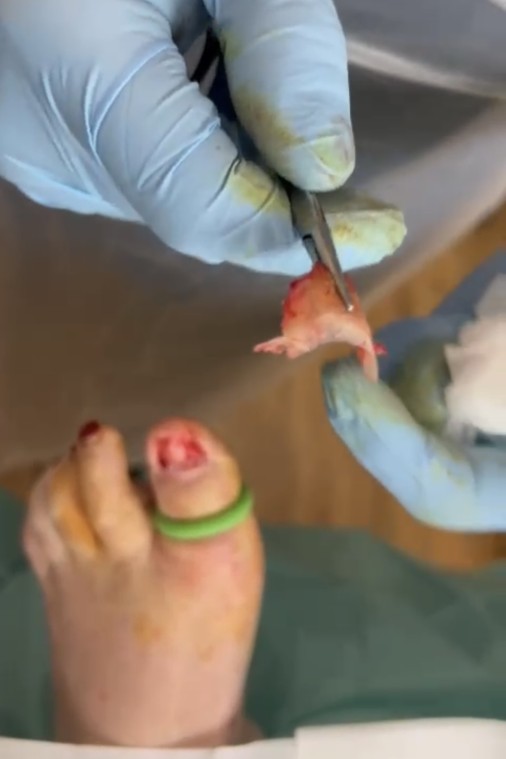 Story Of A Fungal Nail Removal